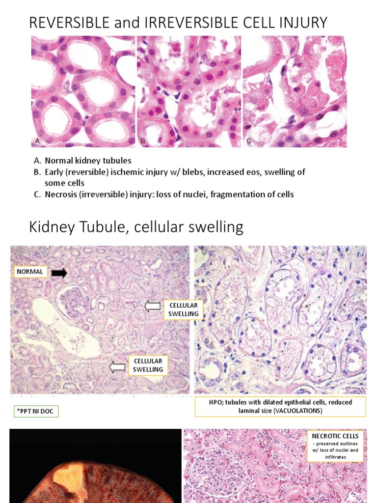 Reversible and Irreversible Cell Injury | PDF | Necrosis | Thrombus