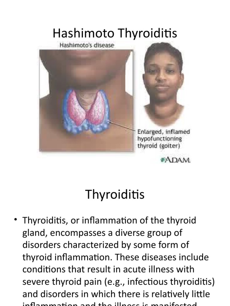 Hashimoto Thyroiditis | PDF | Thyroid | Endocrine Diseases