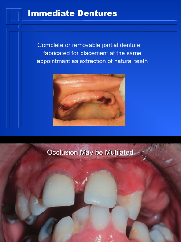 Immediate Denture | PDF | Dentures | Face
