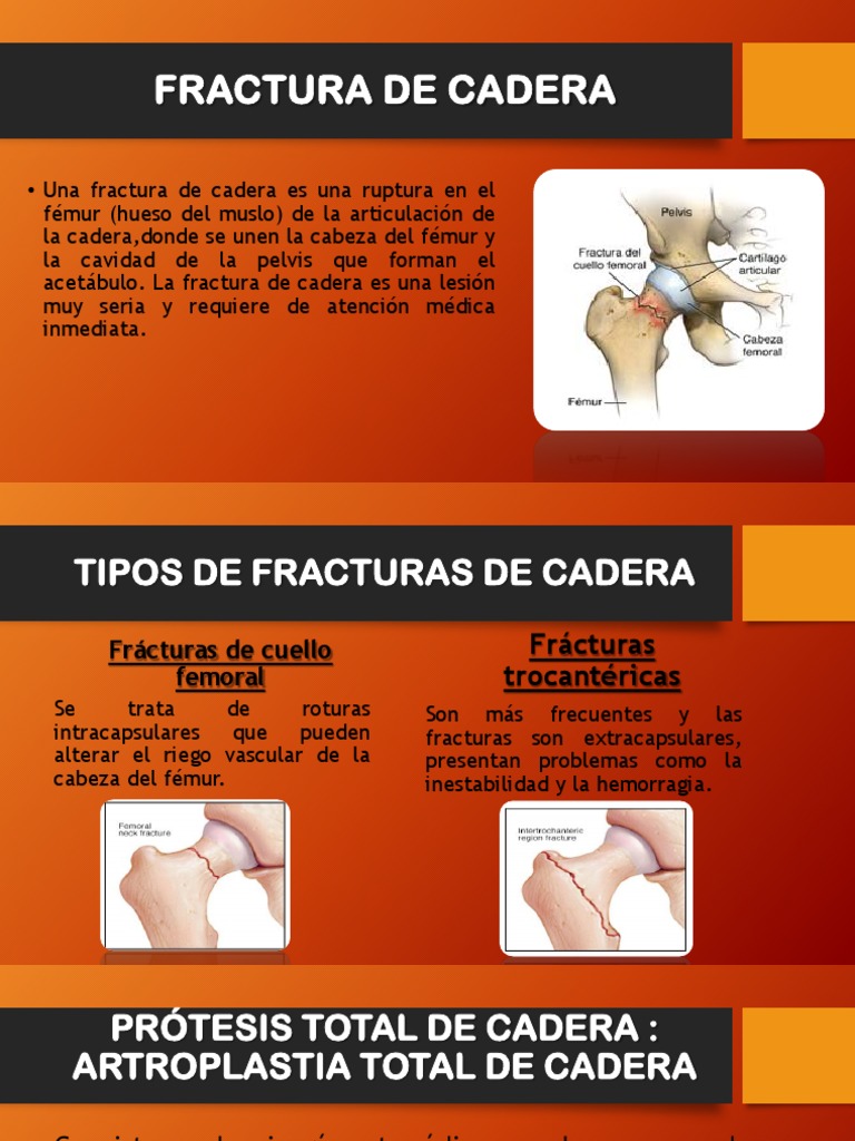 Fractura de Cadera | PDF | Hueso | Medicina CLINICA