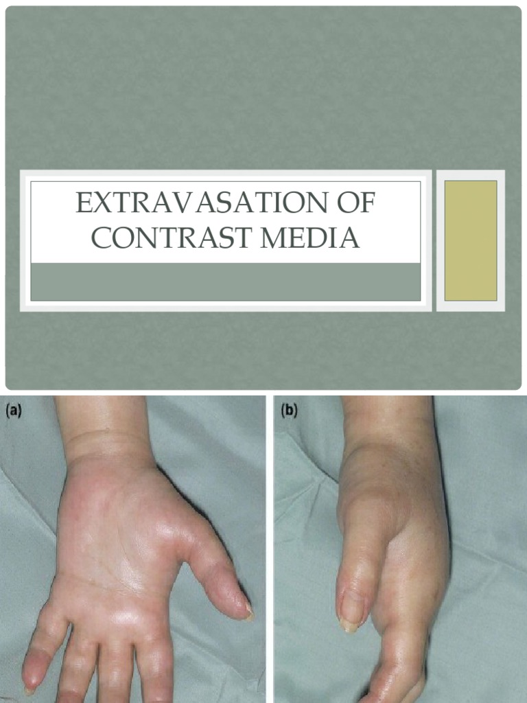 Extravasation of Contrast Media | PDF | Intravenous Therapy | Vein