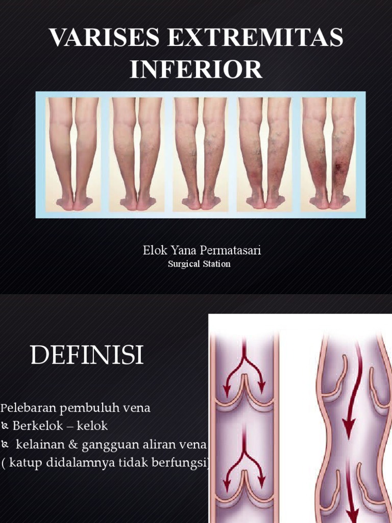 Penanganan Varises Tungkai Bawah | PDF | Kesehatan Holistik | Sains ...