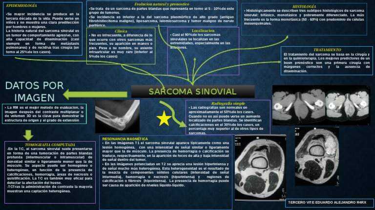 Sarcoma Sinovial | PDF | Sarcoma | Cáncer