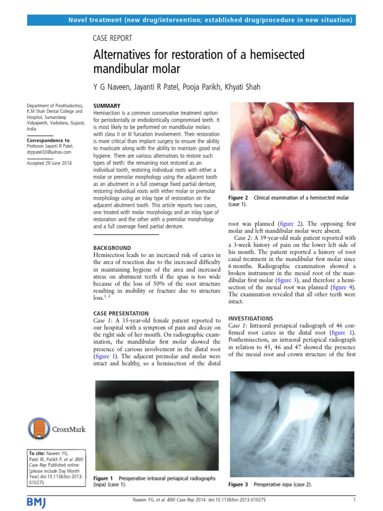 Naveen Et Al. - 2014 - Alternatives For Restoration of A Hemisected ...