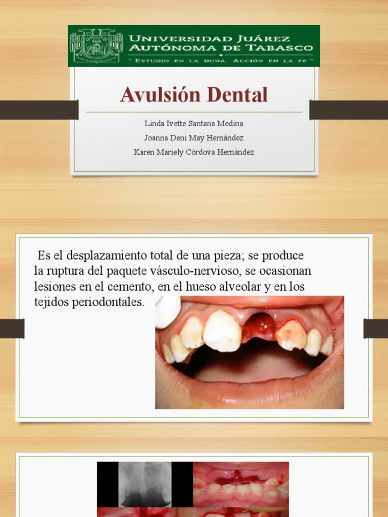 Avulsion Dental | PDF | Enfermedades y trastornos | Medicina