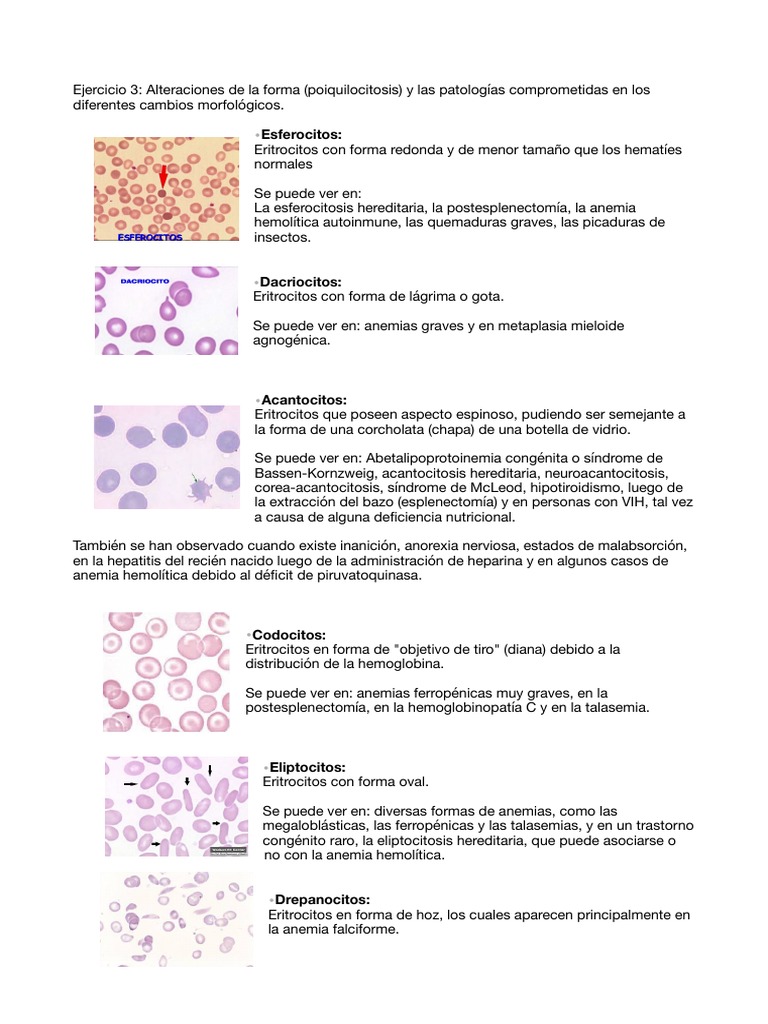 Poiquilocitosis | PDF | Glóbulo rojo | Anemia