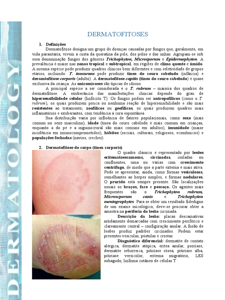 DERMATOFITOSE | PDF | Dermatite | Psoríase
