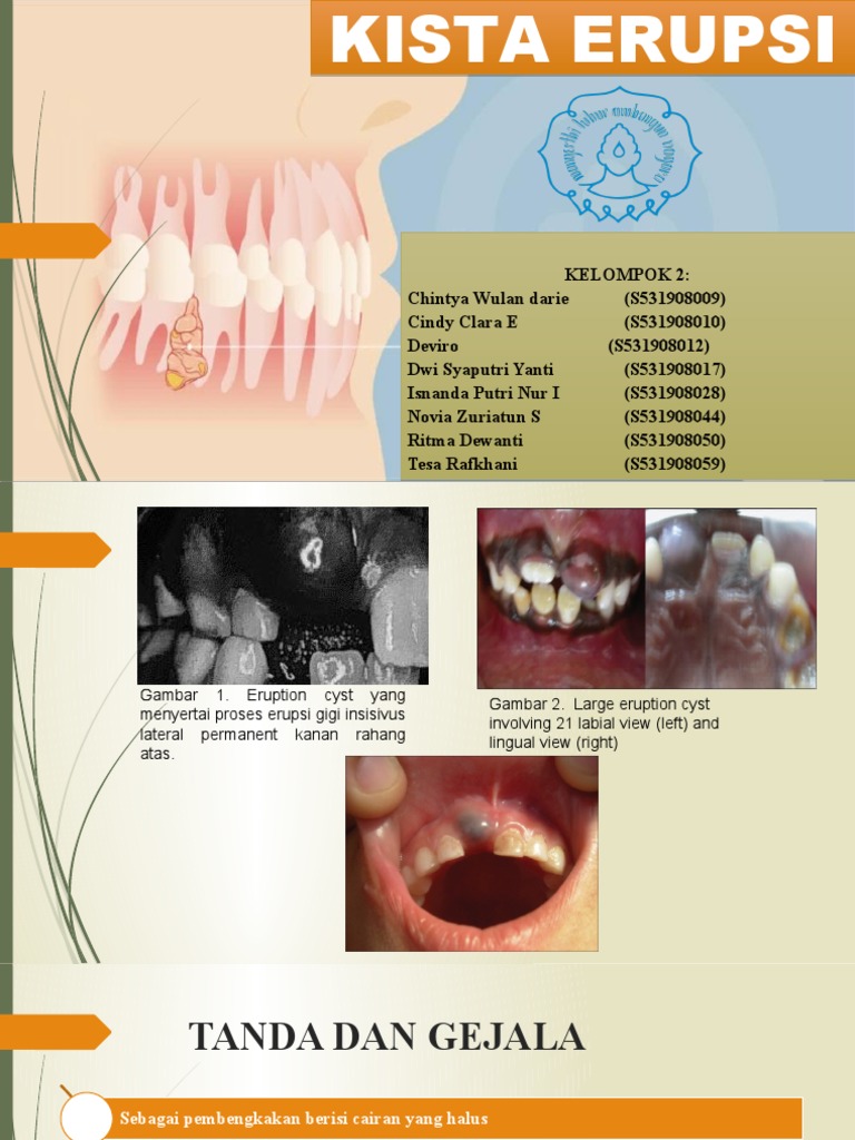 Kista Erupsi Gigi | PDF