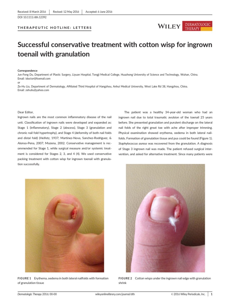 Conservative Treatment of Stage 3 Ingrown Toenail with Granulation ...