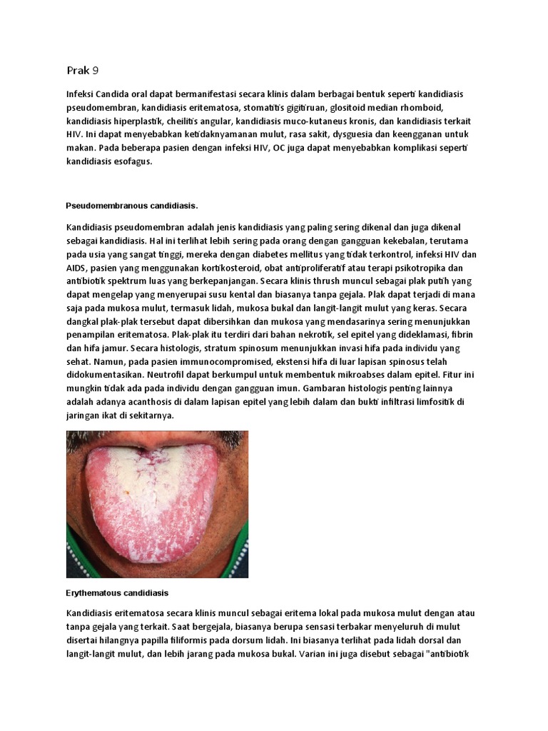 Infeksi Candida Oral Dapat Bermanifestasi Secara Klinis Dalam Berbagai ...