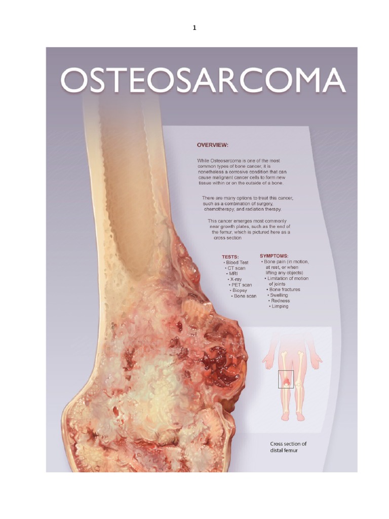 Proceso Osteosarcoma | PDF | Enfermería | Cáncer