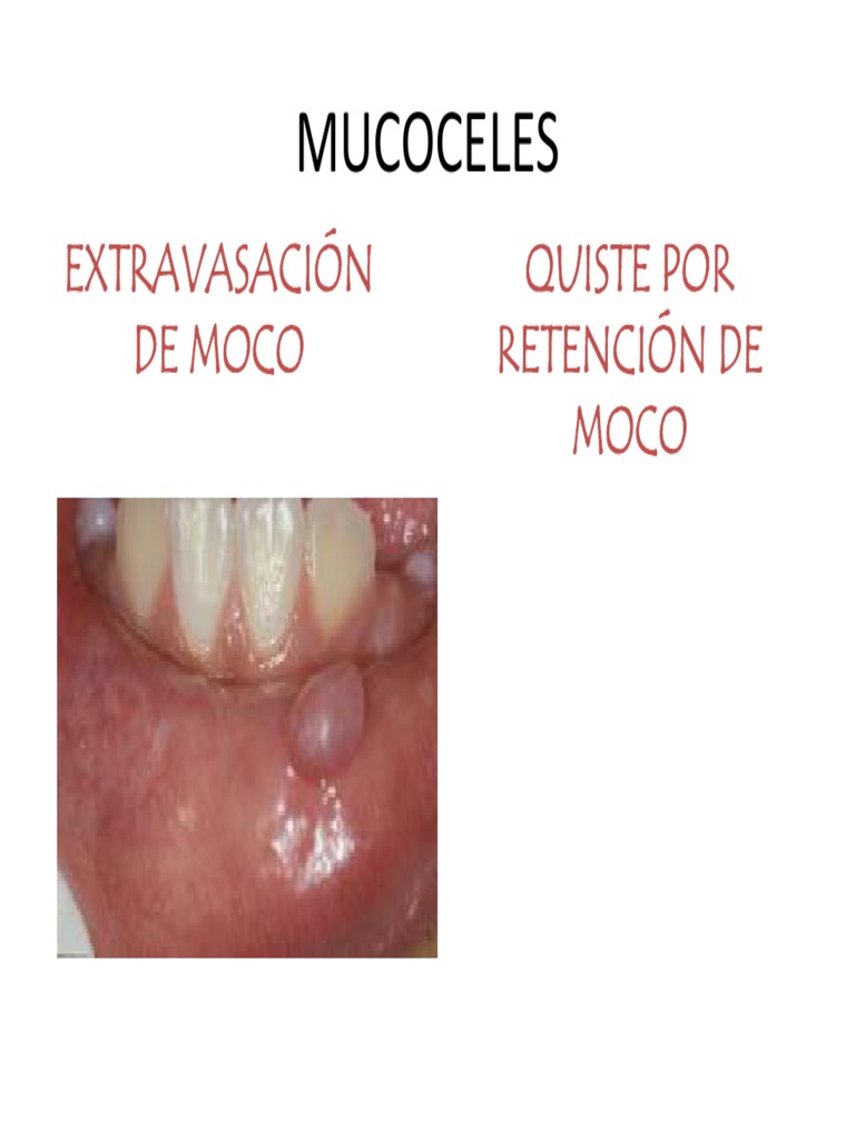 MUCOCELE | PDF | Especialidades Medicas | Enfermedades y trastornos