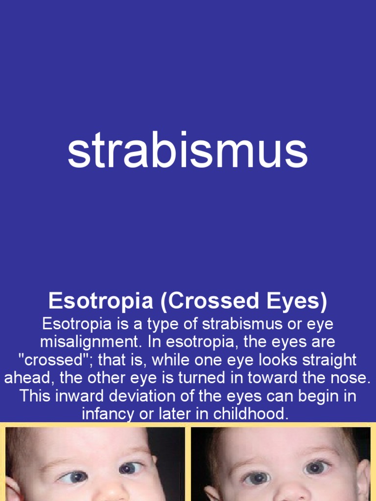 Strabismus | PDF | Visual System | Ophthalmology