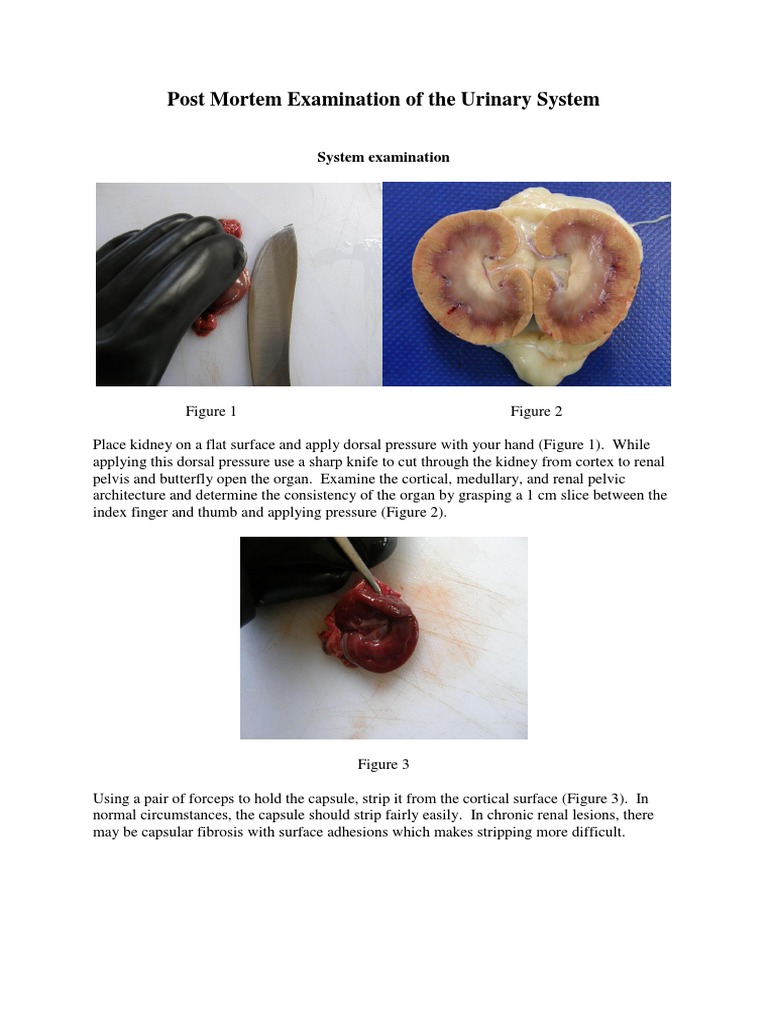 Pulpy Kidney and Size Assessment | PDF | Kidney | Urinary Tract Infection