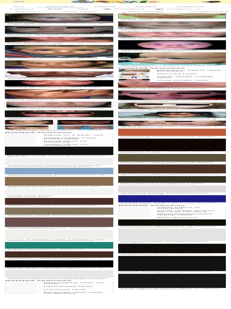 Malar Rash Pediatrics - Google Search | Download Free PDF | Systemic ...