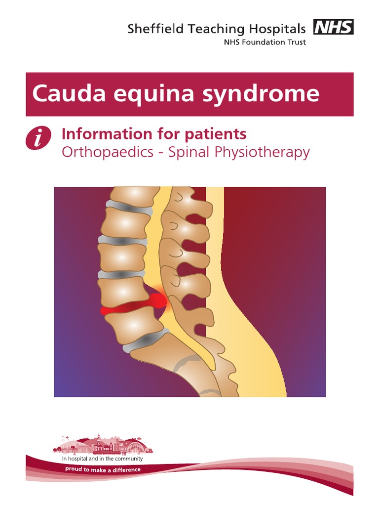 Cauda Equina Syndrome: Information For Patients | PDF | Neurological ...