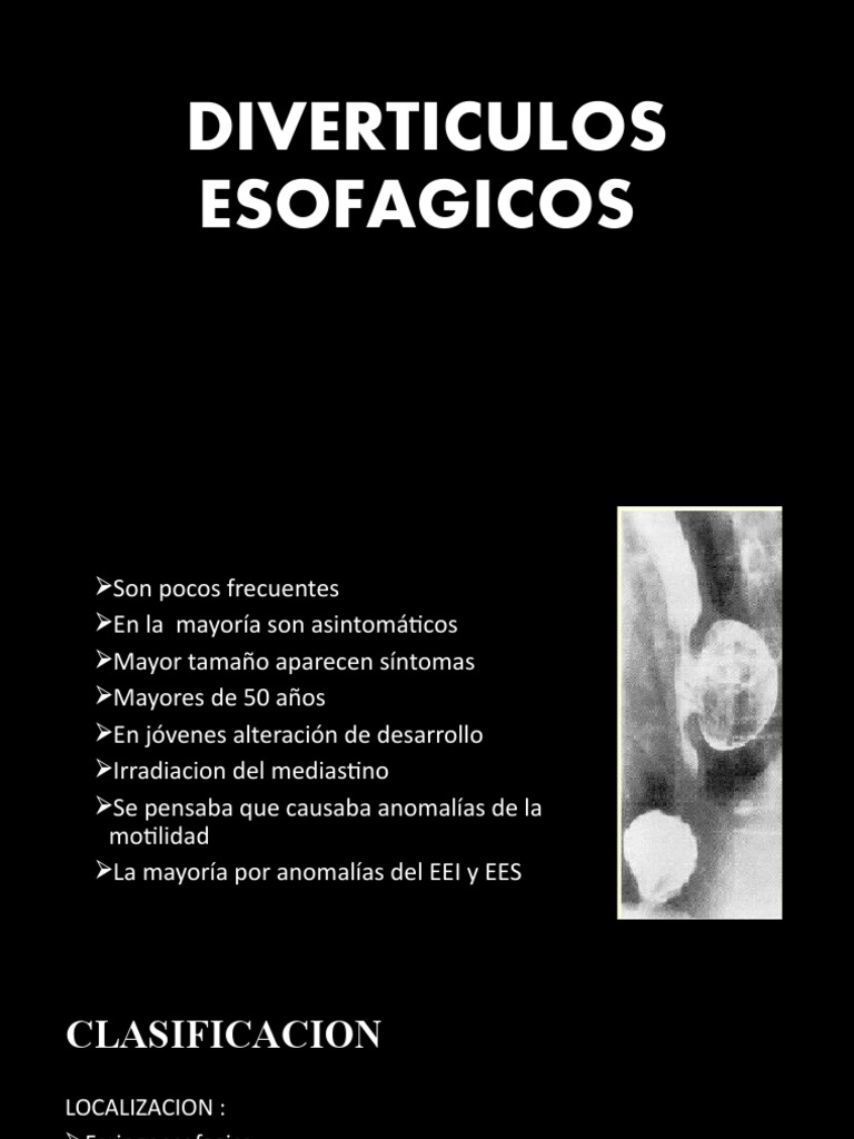 Diverticulos Esofagicos | PDF | Tos | Enfermedades y trastornos
