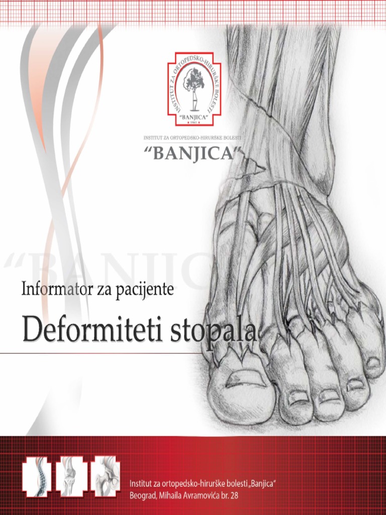 Deformiteti Stopala PDF | PDF