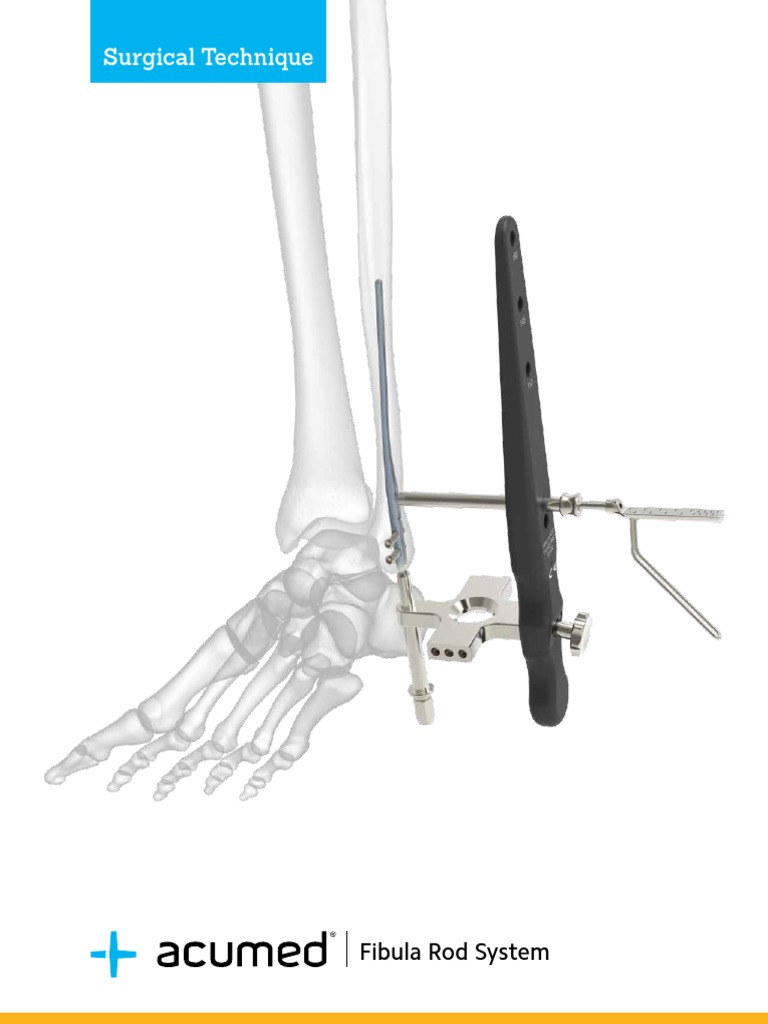 Surgical Technique: Fibula Rod System | PDF | Ankle | Surgery