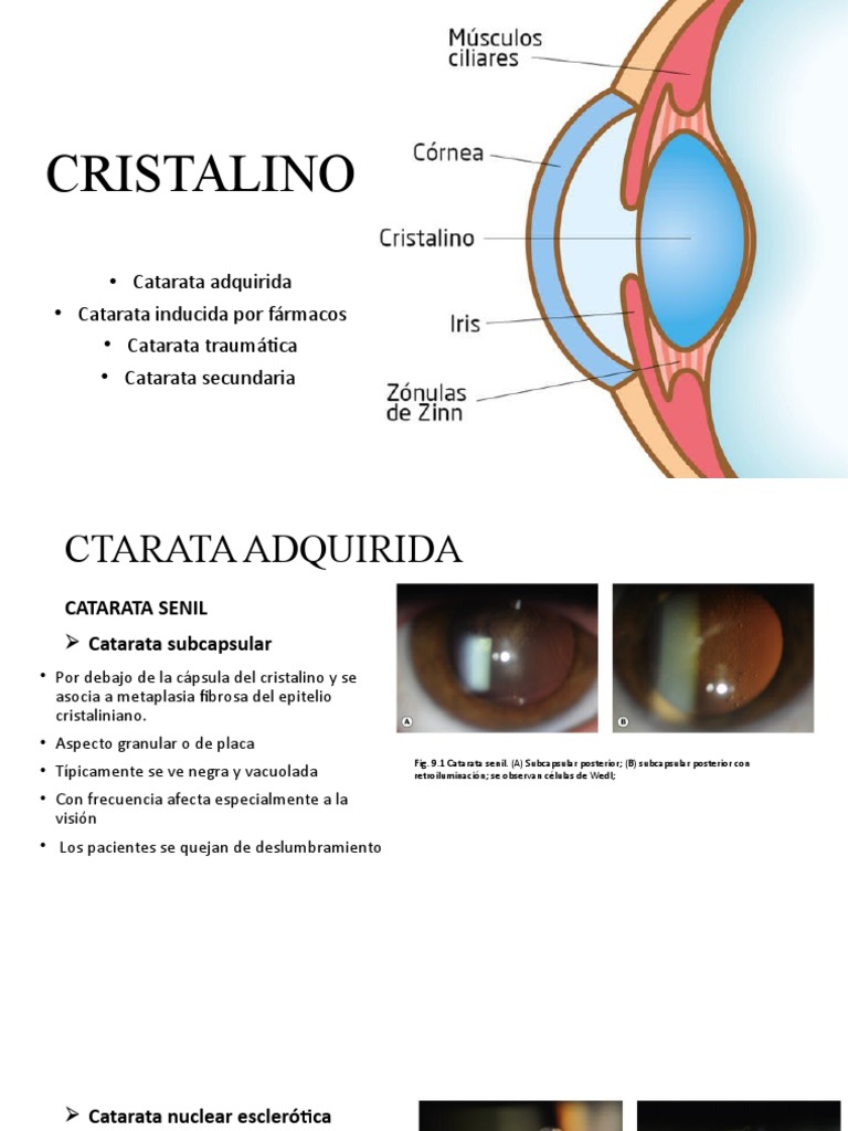 CRISTALINO | PDF | Catarata | Oftalmología