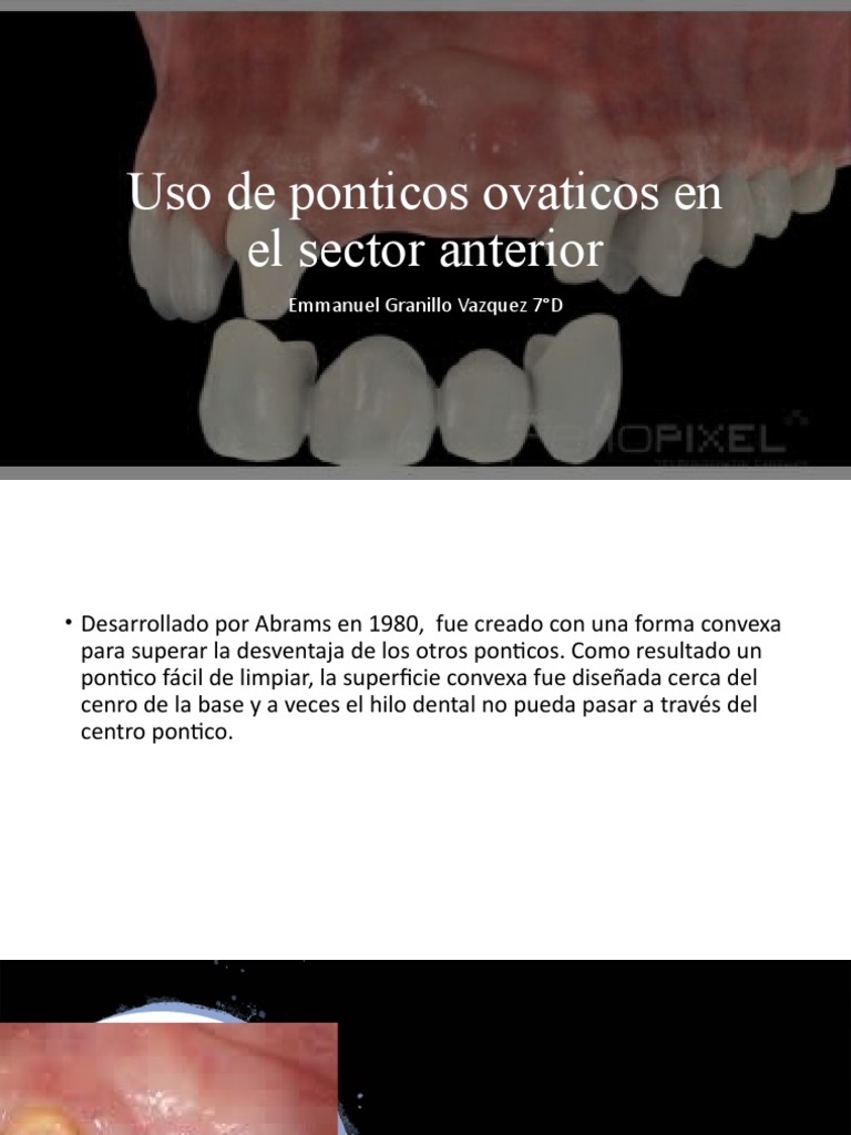 Uso de Ponticos Ovaticos en El Sector Anterior | PDF | Boca ...