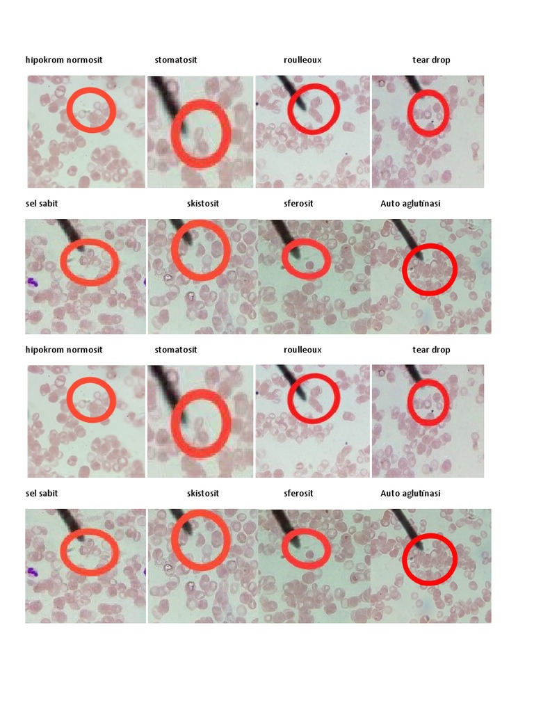 Hipokrom Normositstomatositroulleouxtear Drop | PDF