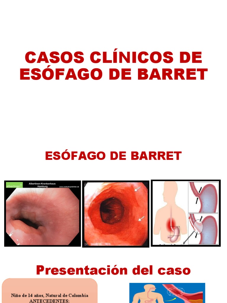 Esófago de Barret | PDF