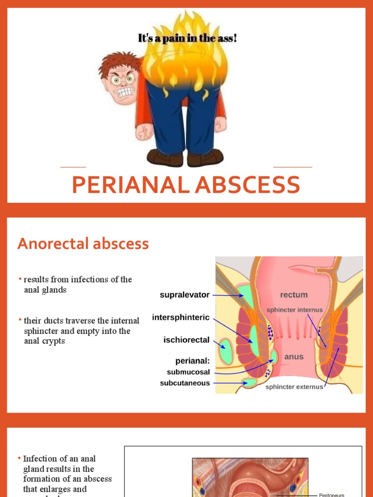 Perianal Abscess