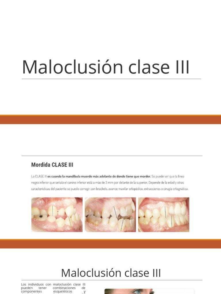 Maloclusión Clase III | PDF | Ortodoncia | Anatomía humana