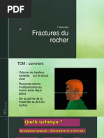 Fracture du rocher : enjeux cliniques | PDF | vertige | Traumatisme crânien
