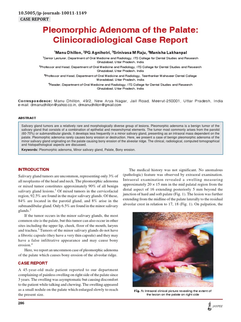 Pleomorphic Adenoma of The Palate: Clinicoradiological Case Report ...