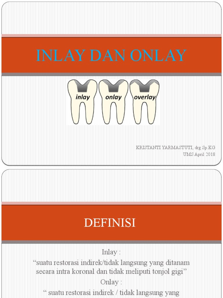 Kuliah Inlay Dan Onlay | PDF