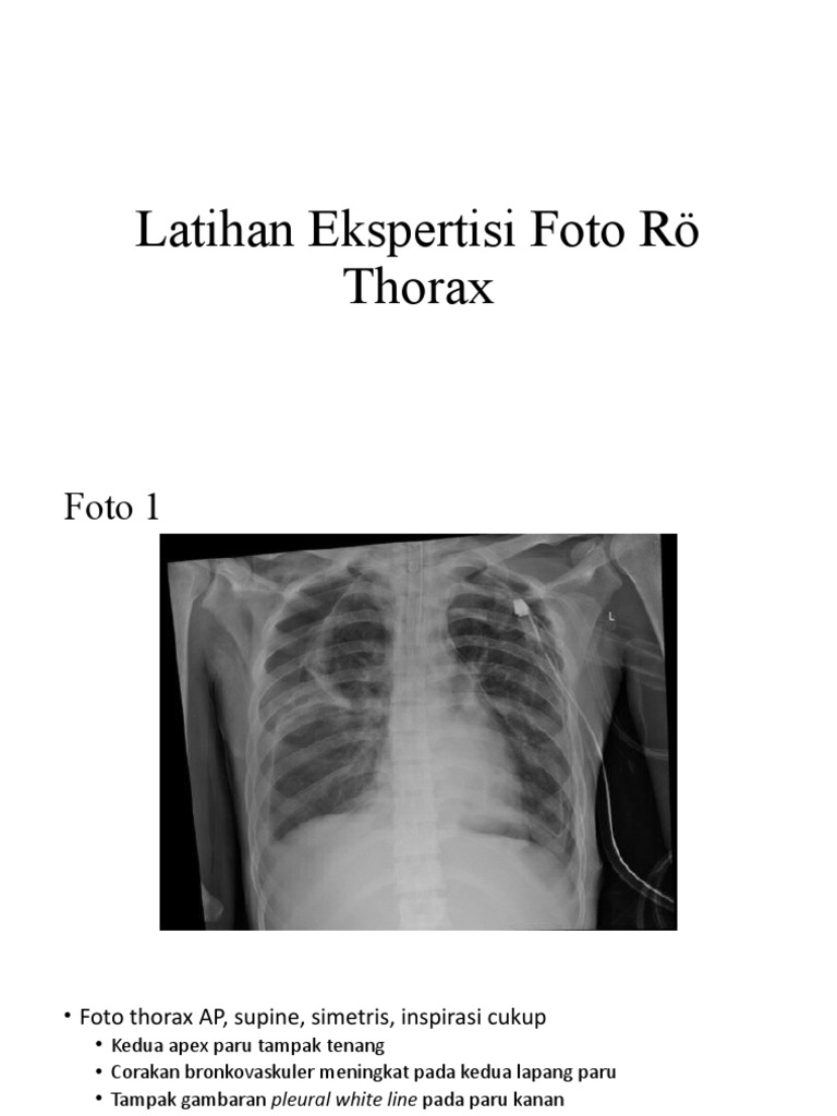 Latihan Ekspertisi Foto Rӧ Thorax | PDF