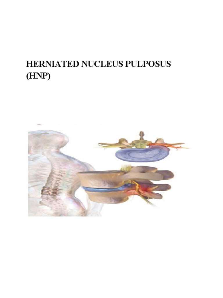 Herniated Nucleus Pulposus | PDF