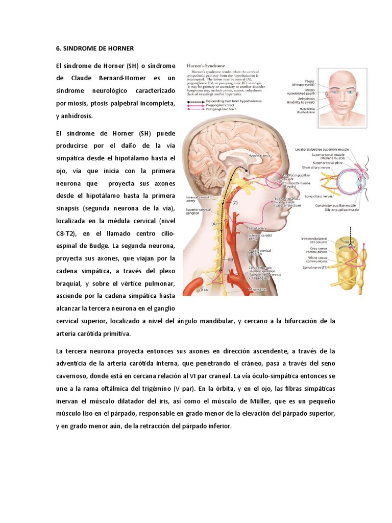 6 Sindrome de Horner | PDF | Enfermedades y trastornos | Anatomía humana