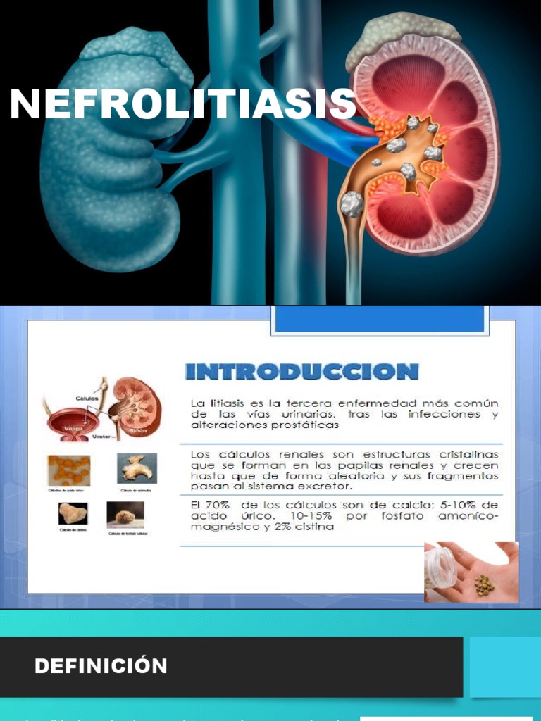 NEFROLITIASIS | PDF | Enfermedades y trastornos | Química