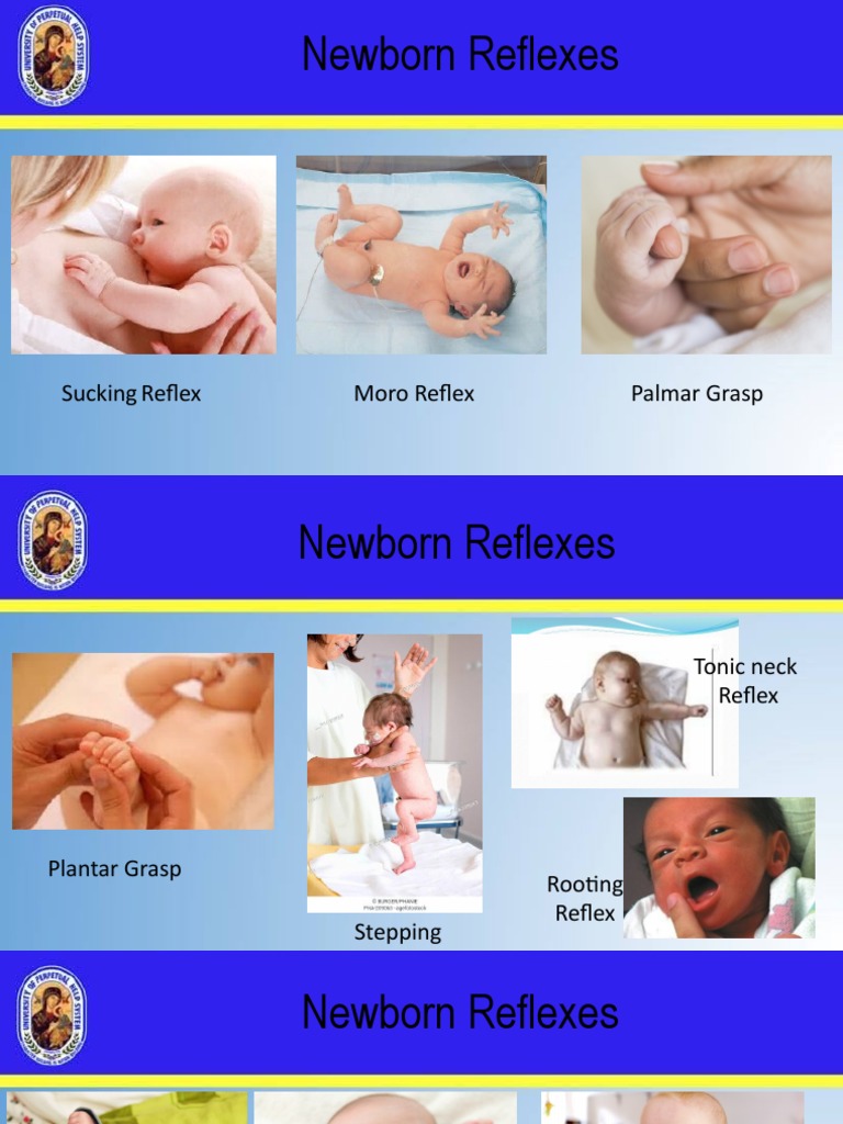 Newborn Reflexes: Sucking Reflex Palmar Grasp Moro Reflex | PDF