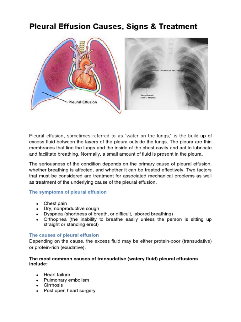 Pleural Effusion Causes, Signs & Treatment Guide | PDF | Epidemiology ...