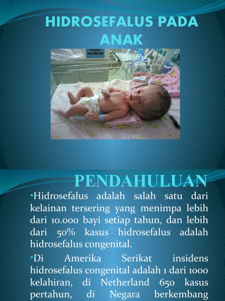 Hidrosefalus Pada Anak | PDF