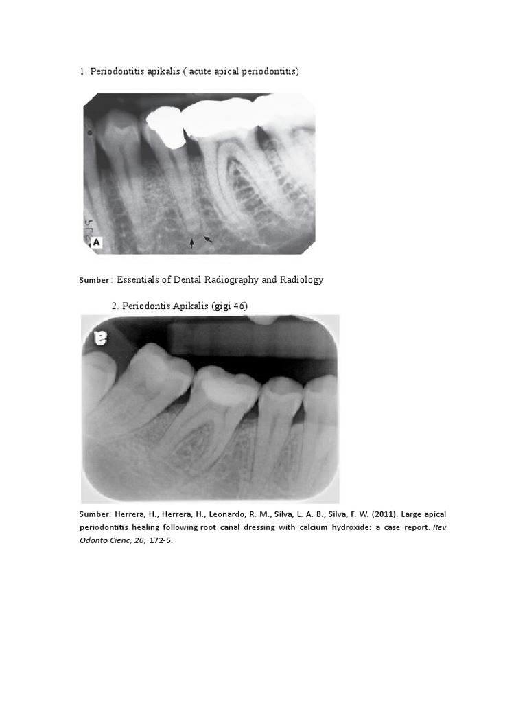 Acute Apical Periodontitis