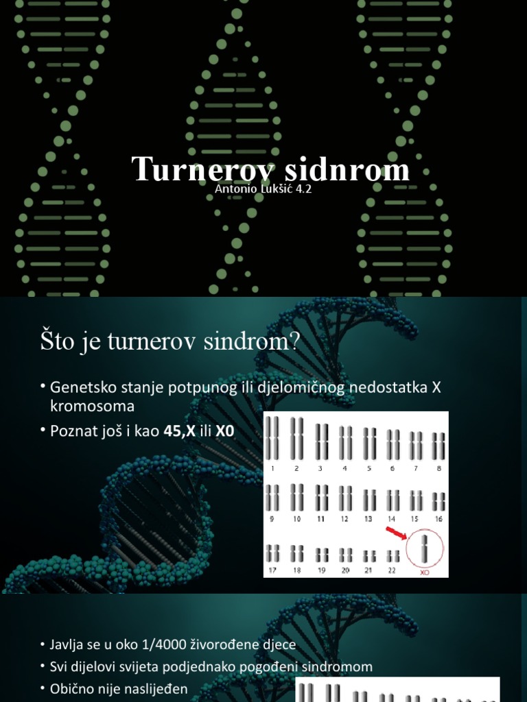 Turnerov Sindrom | PDF