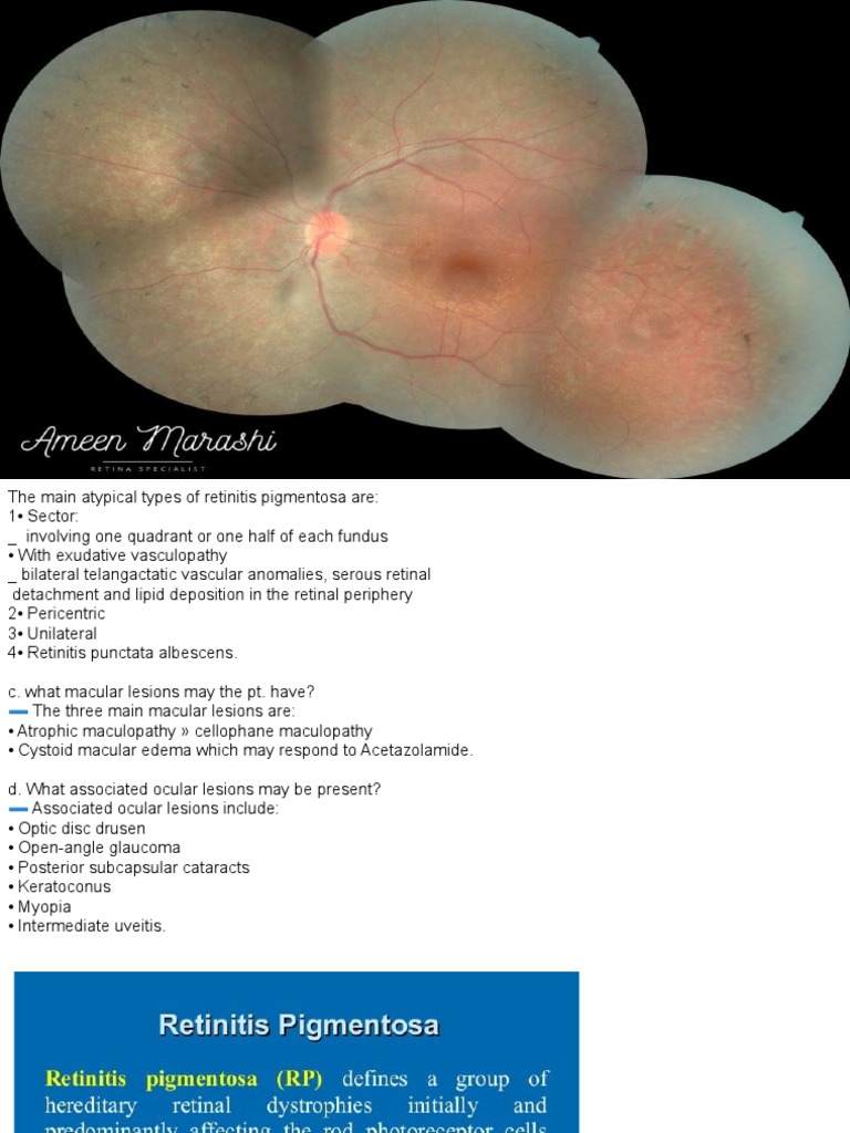 Retinitis Pigmentosa | PDF | Retina | Diseases Of The Eye And Adnexa