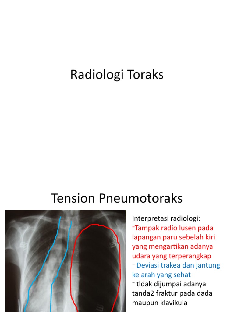 Radiologi Toraks | PDF