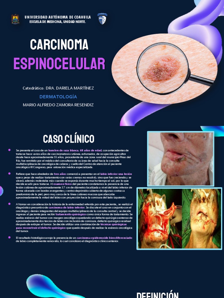 Carcinoma Epidermoide | PDF | Metástasis | Cáncer