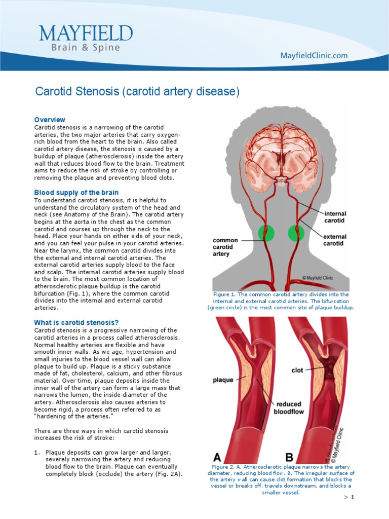 Carotid Stenosis (Carotid Artery Disease) | PDF | Atherosclerosis ...