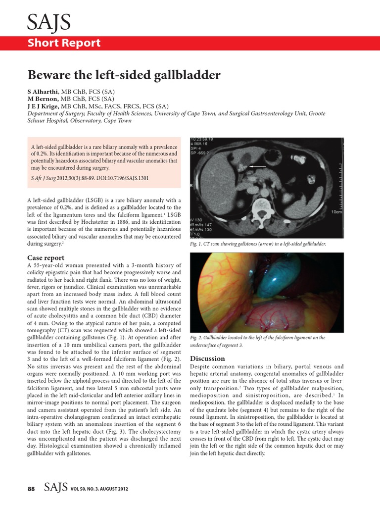 Beware The Left-Sided Gallbladder: Short Report | PDF | Gallbladder | Liver