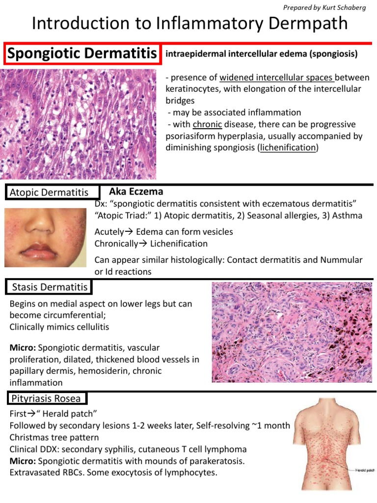 Spongiotic Dermatitis: Aka Eczema | PDF | Dermatitis | Epidermis