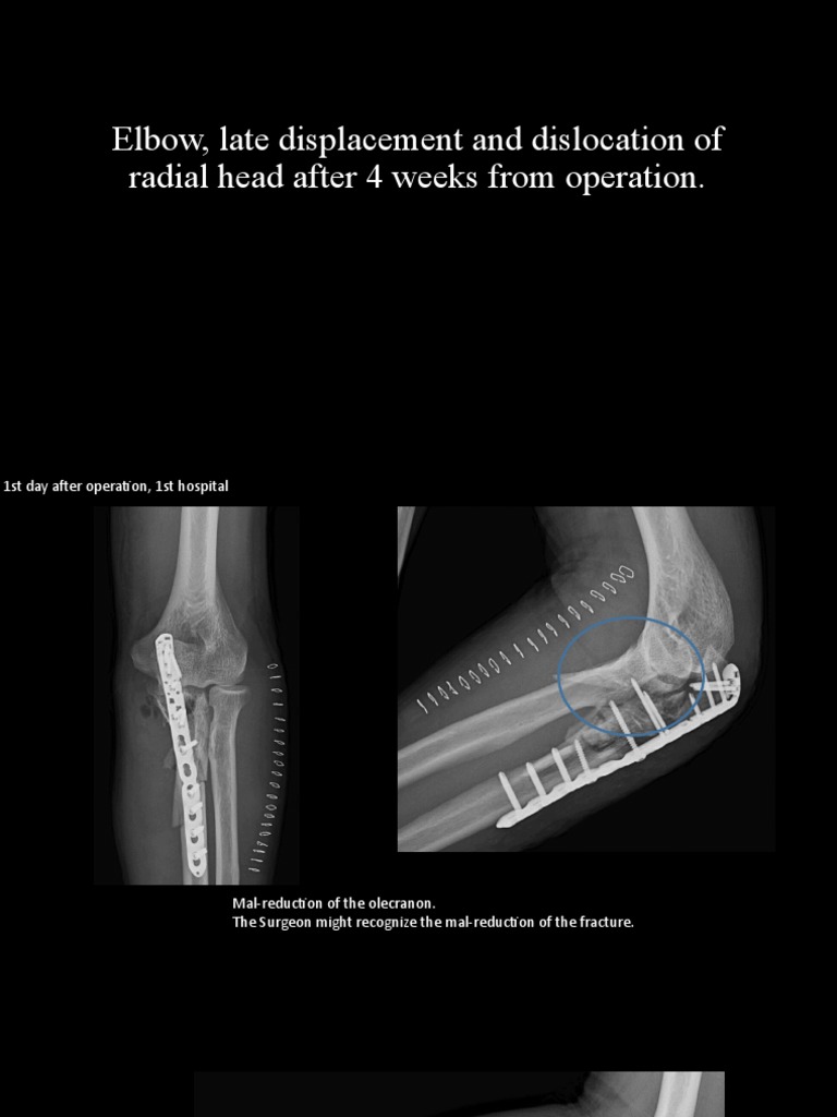 Elbow Delayed Radial Head Dislocation | PDF