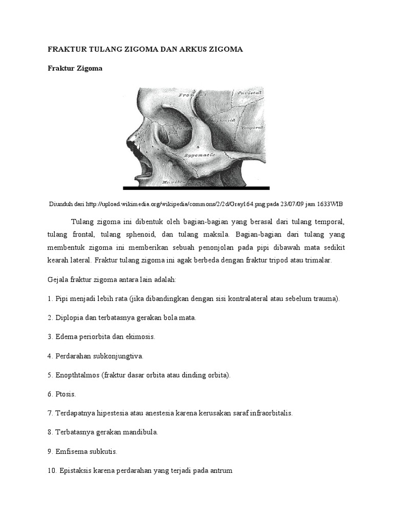 FRAKTUR TULANG ZIGOMA DAN ARKUS ZIGOMA (Refrat 2) | PDF