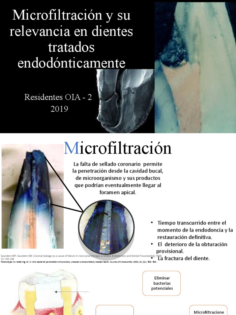 Twma 1 Microfiltraciónen Dientes Tratados Endodónticamente | PDF ...
